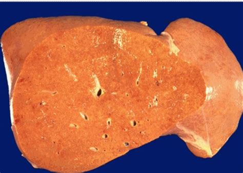 Pathology 13 Biliary Disorders Flashcards Quizlet