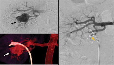 Catheter Angiography Black Arrow And Computed Tomography Download Scientific Diagram