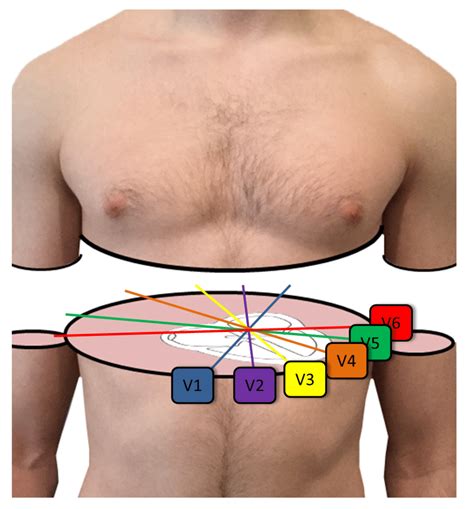 Wpw Ecg Findings Sekaarchitecture