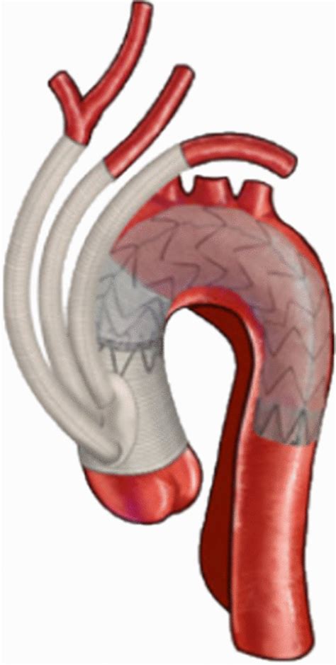 Comparison Of Two Surgical Approaches For Acute Type A Aortic Dissection Hybrid Debranching
