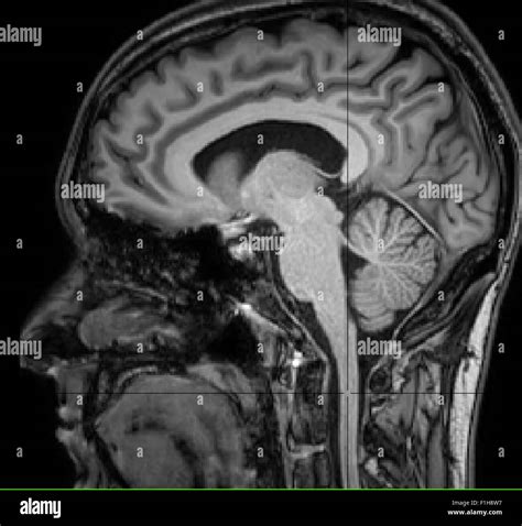 Gehirn Anatomie Sagittale Ansicht Fotos Und Bildmaterial In Hoher