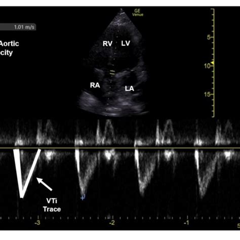 Pulse Doppler Waveform Measuring Peak Aortic Velocity And Velocity Download Scientific