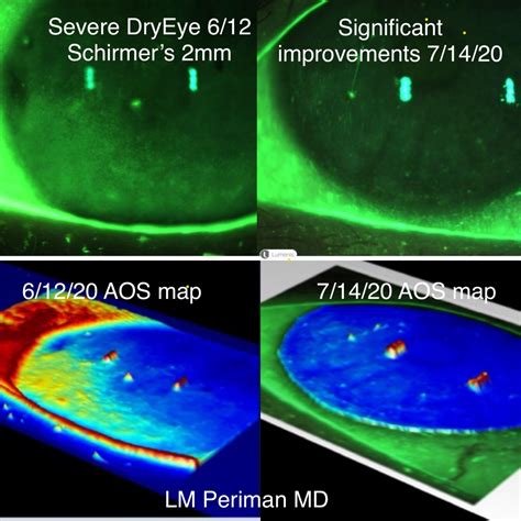 Spk Gallery Dry Eye Master