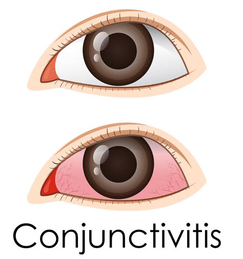 Conjunctivitis Types Inflammatory Diseases Of Eyes Cartoon Vector My Xxx Hot Girl