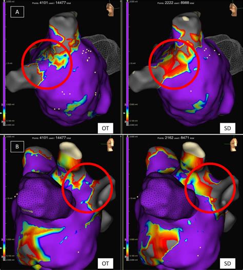 The Omnipolar Mapping Technology—a New Mapping Tool To Overcome Bipolar Blindness” Resulting In