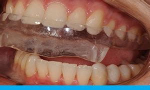 13 Permanent Tmj Splint MoaphaRisha