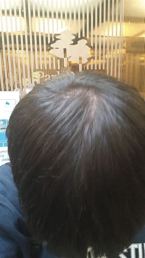 선천적으로 머리가 얇고 숱이 많은 편이 아니였는데 고3이 되고나서 뭔가 더 비어보이는거 같아 질문드립니다 궁금할 땐 아하