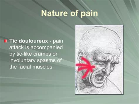 Trigeminal Neuralgia Pptx