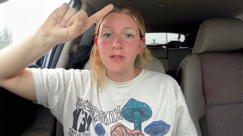 I Got A Terrible Sunburn All Over And My Face Was Peeling My 5