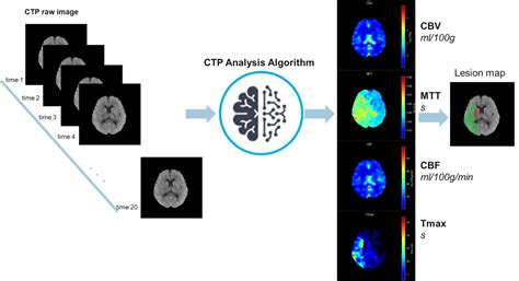 Brain Perfusion Scan Ctp Imaging Analysis China Medical University Hospital