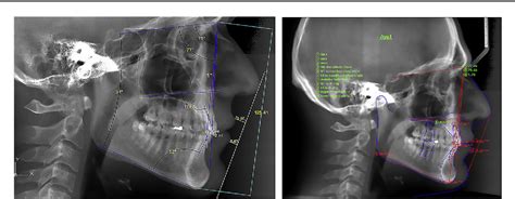 Figure 1 From The Accuracy And Reliability Of Webceph For Cephalometric