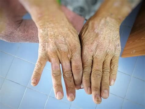 Scleroderma What You Need To Know Activebeat Your Daily Dose Of
