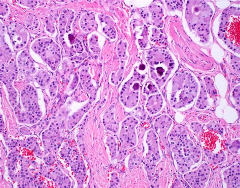 Carcinoid Syndrome Histology