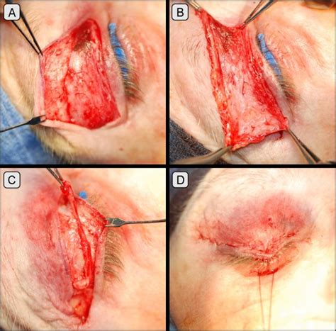 Surgical Approach To Limiting Skin Contracture Following Protractor Myectomy For Essential