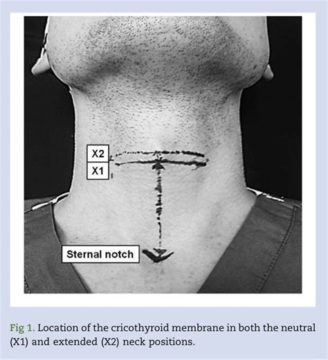 Cricothyroid Membrane Incision