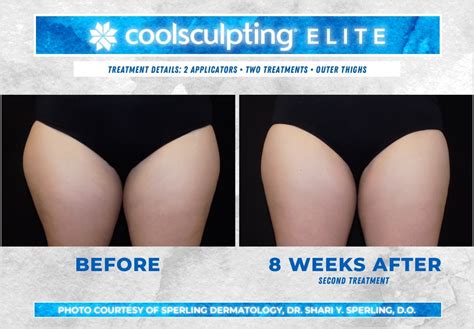 Before And After Coolsculpting Photos