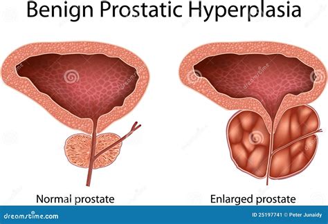 Benign Prostatic Hyperplasia Royalty Free Illustration 102631191