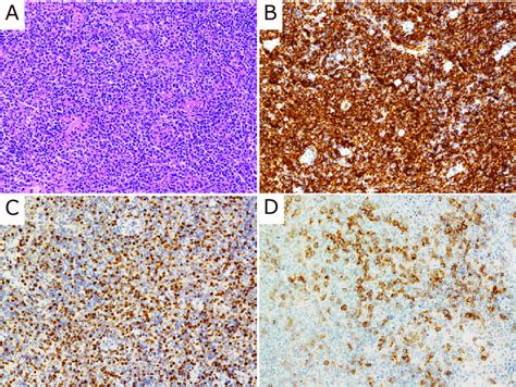 Ebv Positive Dlbcl Type Oii Lpd A Marked Infiltration Of Large