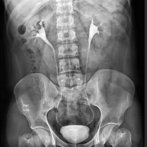 Ct Scan Pyelogram Test Near Me Yamuna Vihar Cost Ganesh Diagnostic