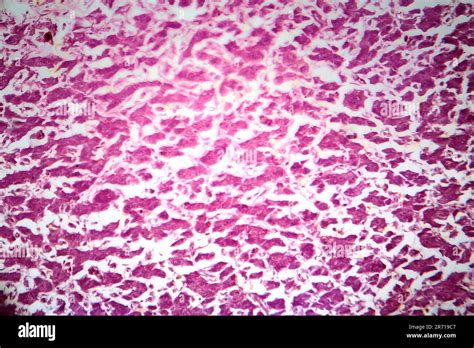 Histopathology Of Acute Severe Hepatitis Light Micrograph Photo Under
