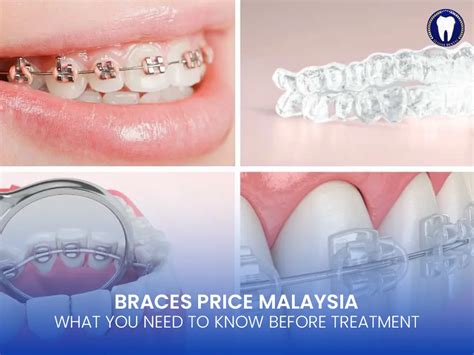 Braces Price And Cost In Malaysia What You Should Know