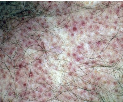 Microbiology 3200 Staph And Strep Flashcards Quizlet