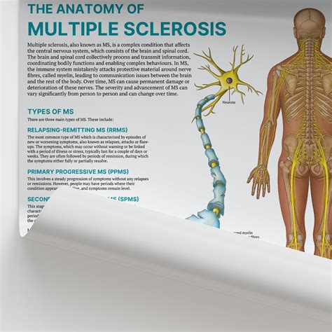 Types Of Multiple Sclerosis Chart