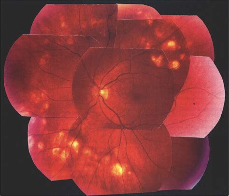Composite Photograph Of The Left Fundus Showing Idiopathic Download Scientific Diagram