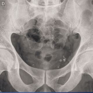 Soft Tissue Calcifications Flashcards Quizlet