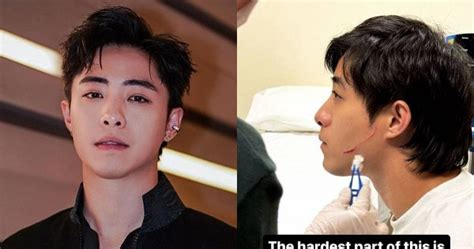 My Face Felt Hot Zong Zijie Suffers 10cm Cut On Cheek While Filming