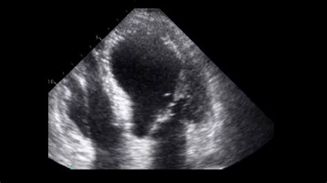 New Insights Into Mortality In Takotsubo Syndrome