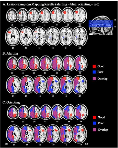 Figure 2 From Auditory Attention Following A Left Hemisphere Stroke Comparisons Of Alerting