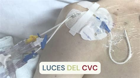 QuÉ Va En Cada LÚmen Del CatÉter Venoso Central Youtube