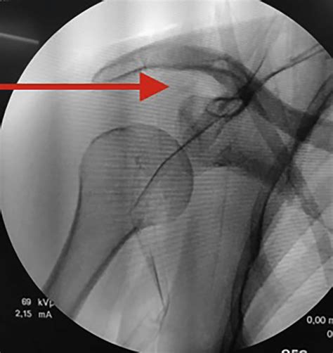 Intraoperative Control Fluoroscopy Intramuscular Calcification Above Download Scientific