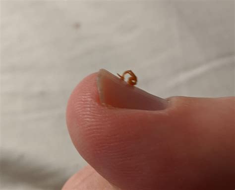 Old Scrotum Pimple Puss Was Very Gritty Popping
