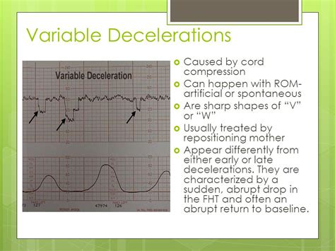 Chapter 17 Intrapartum Fetal Surveillance Ppt Download