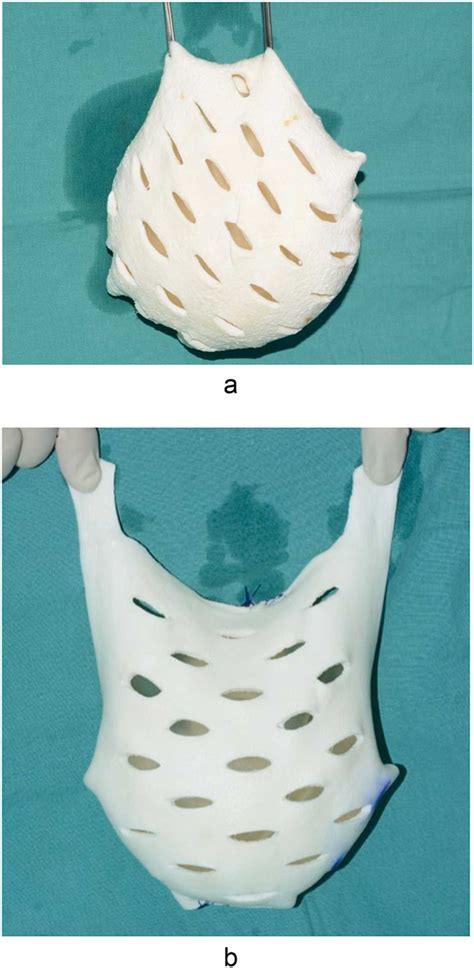 Difference In The Outcomes Of Anterior Tenting And Wrapping Techniques For Acellular Dermal