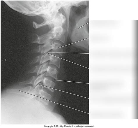 Lateral C Spine Diagram Quizlet