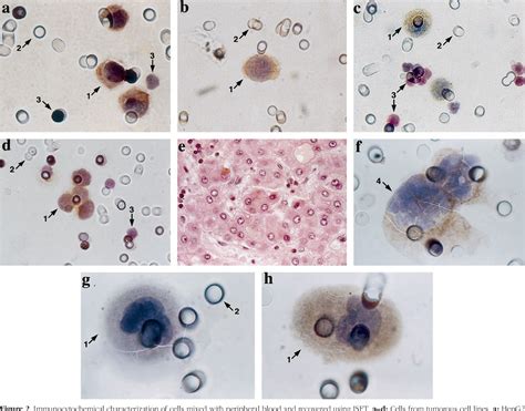 Figure 2 From Technical Advance Isolation By Size Of Epithelial Tumor Cells A New Method For The