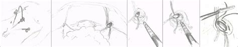 Pediatric Laparoscopic Inguinal Hernia Repair A Review Of Techniques