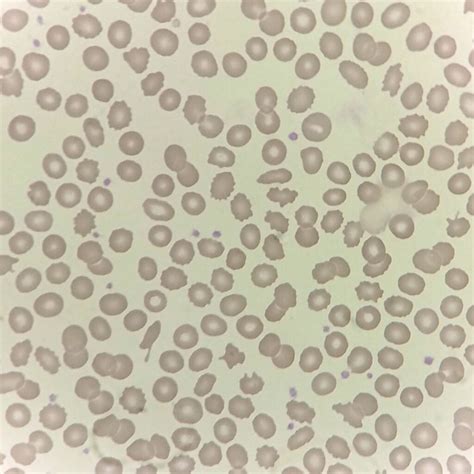 Burr Cells Echinocytes Hematology Bench And Mls Study Guide