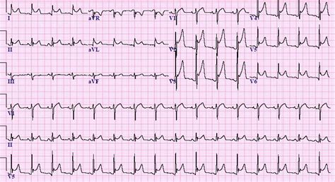 Physical Activity Recommendations In Patients With Acute Pericarditis American College Of