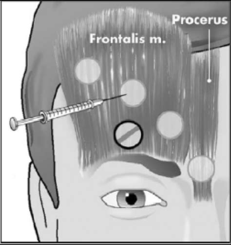 anterior injection sites in procerus and frontalis muscles download