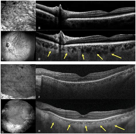 Normal Retina Oct