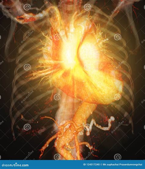 Cta Coronary Artery 3d Rendering Stock Illustration Illustration Of Human Coronary 124517240