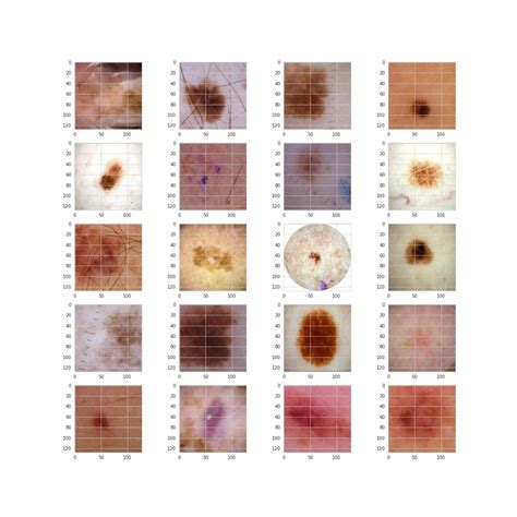 Melanoma Prediction Kaggle Contest Part 1 Contest And Exploration Sam Hatfield