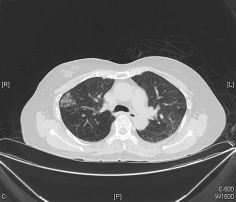 cancer patients lungs ct image lidc idri dataset [19] download