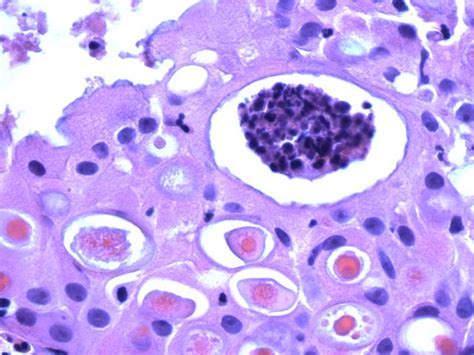Week 337 Case 6 Johns Hopkins Surgical Pathology Unknown Conference