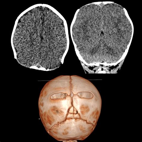 Parietal Foramina Pediatric Radiology Reference Article Pediatric
