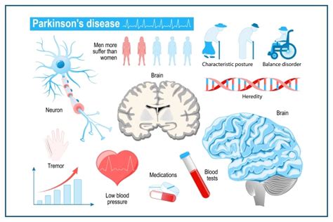 Article About Parkinson`s Disease